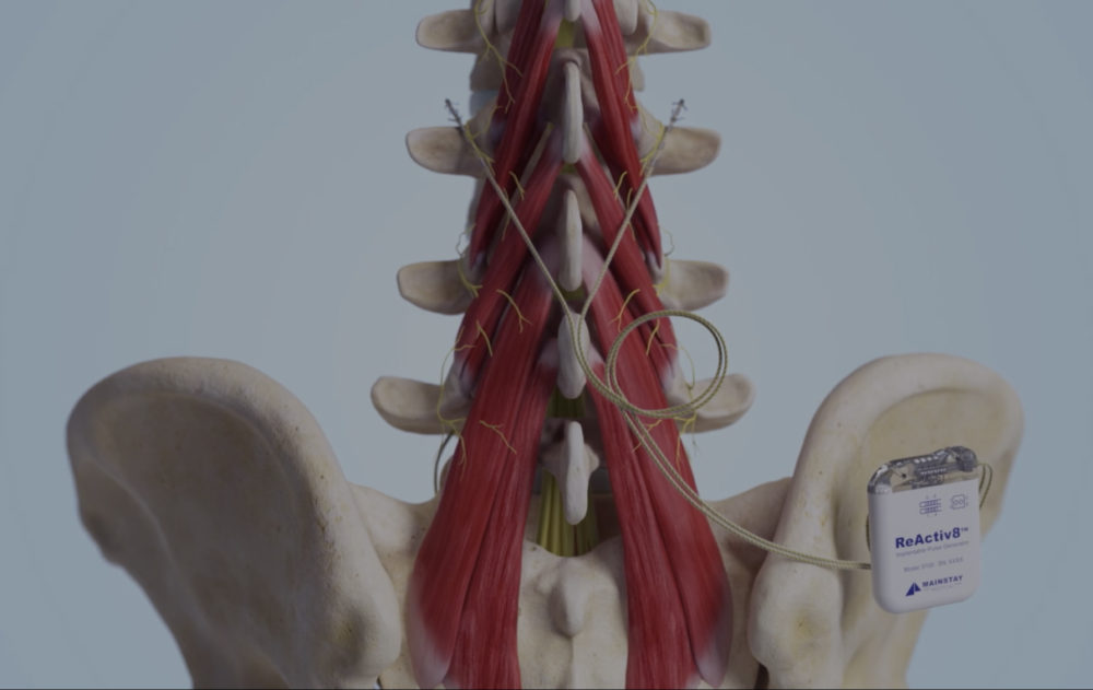 ReActiv8 Physician Information | Mainstay Medical Australia