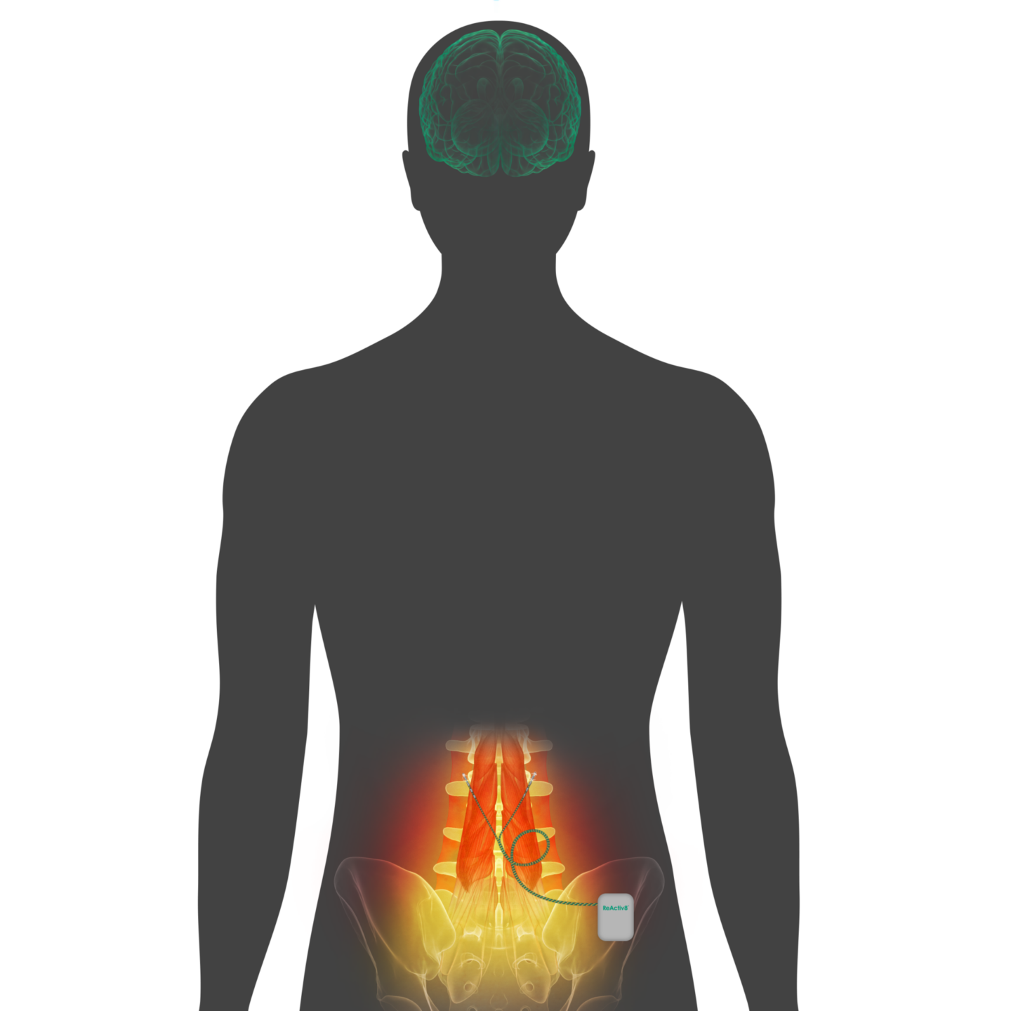 ReActiv8 | Restorative Neurostimulation | Australia