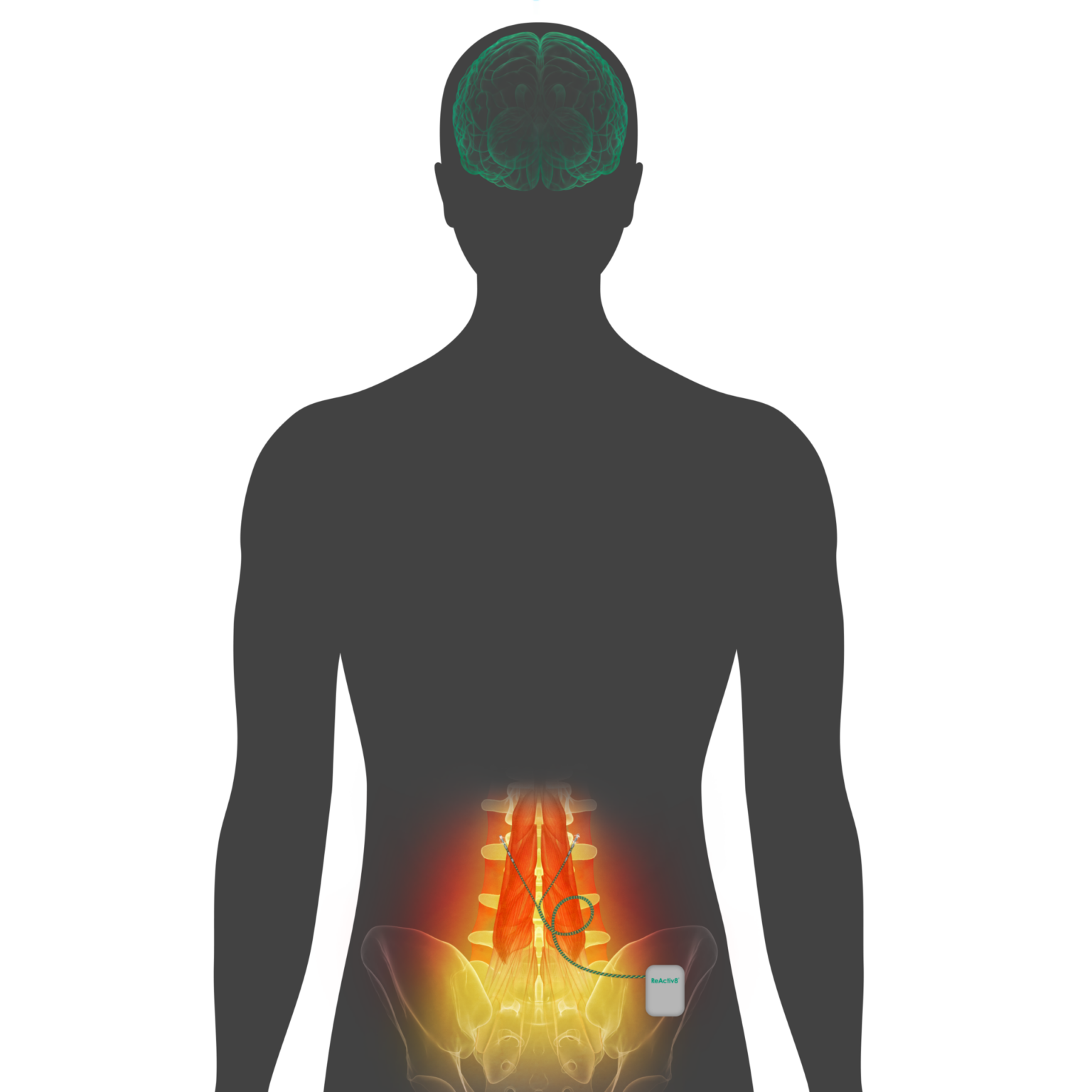 ReActiv8 | Restorative Neurostimulation | Australia